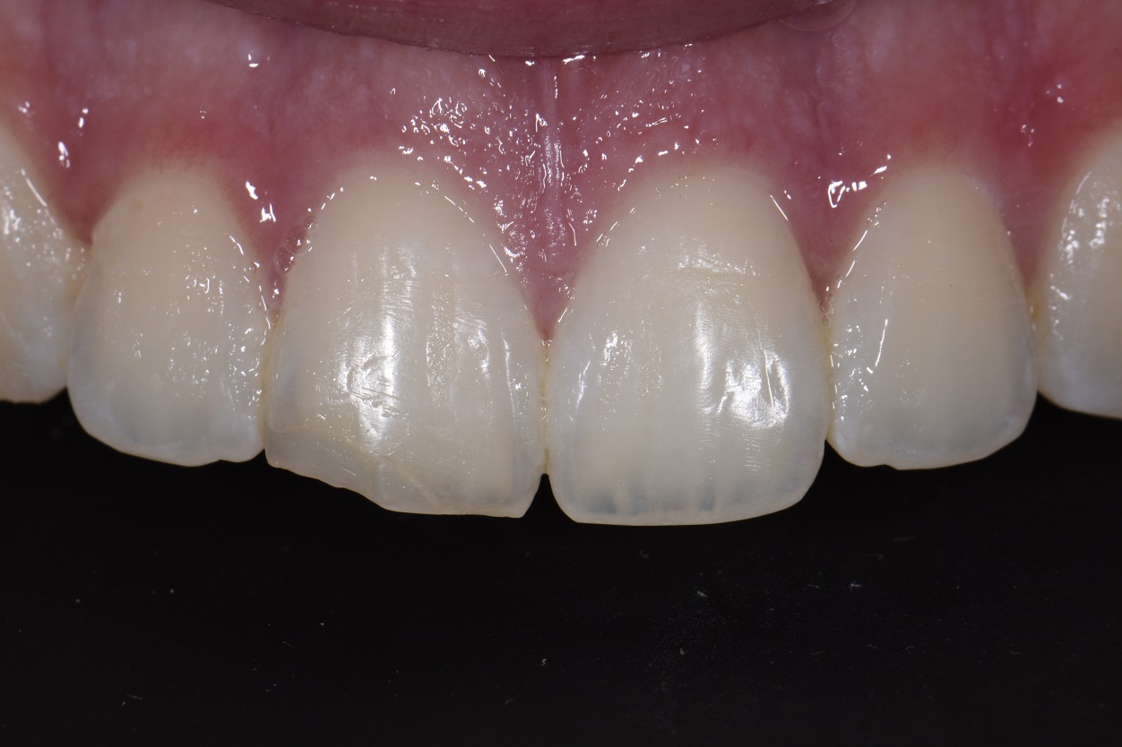 Recreating Nuances of Nature in Fractured Front Teeth