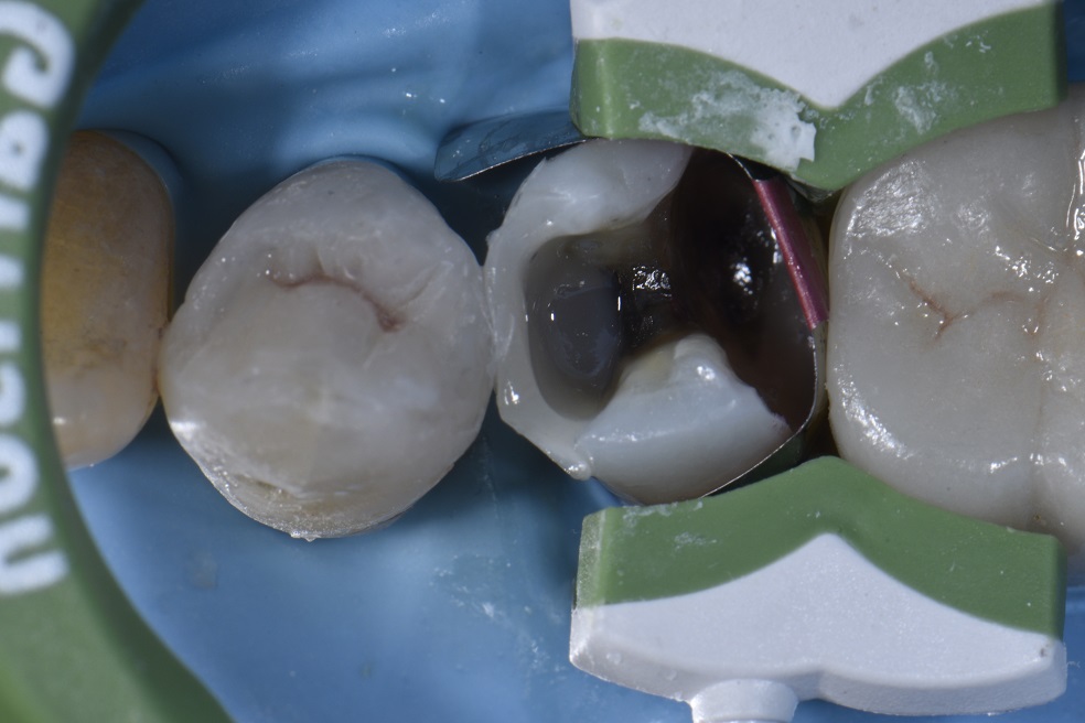 Replacing Amalgam with Garrison Wide Prep Compositight 3D Fusion