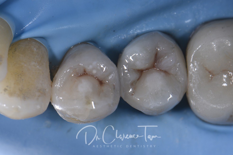 Replacing Amalgam with Garrison Wide Prep Compositight 3D Fusion
