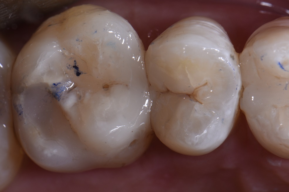 Back to Back slot amalgam replacements