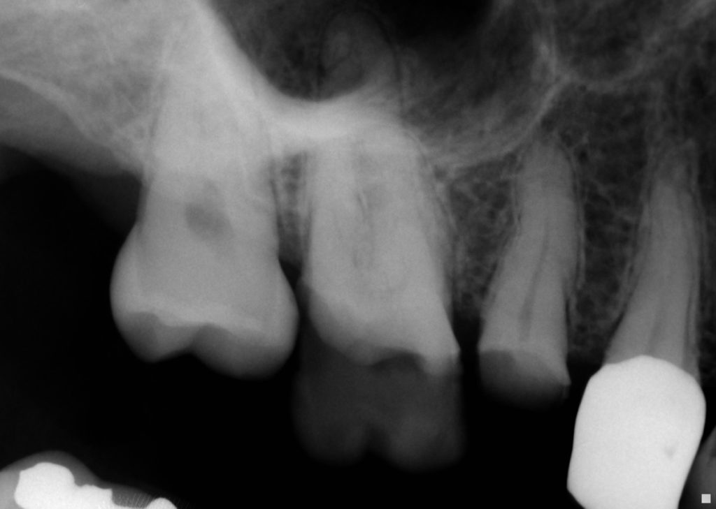 Ultradent Unicore Post