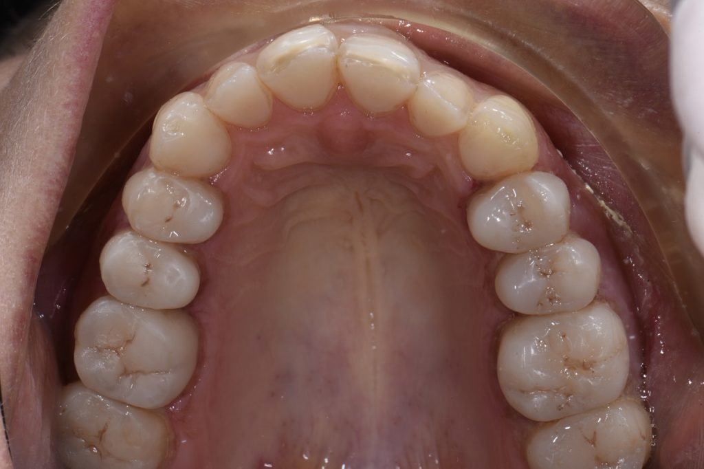 Protecting teeth affected by bulimia