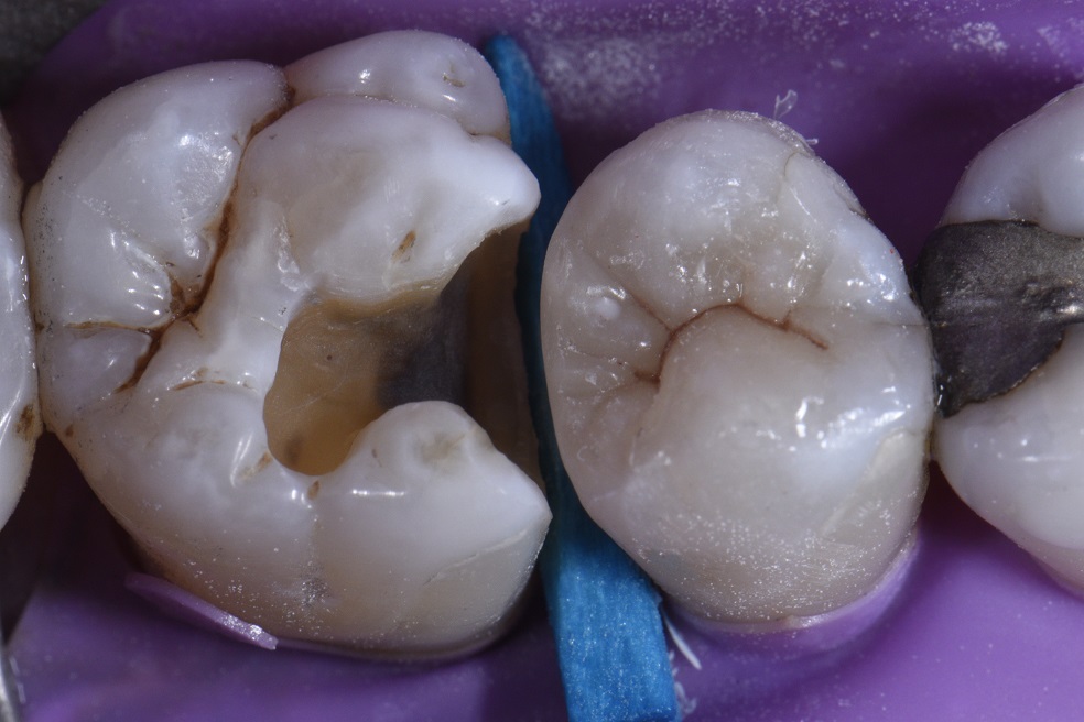 Natural Looking Amalgam Replacements on my Mom