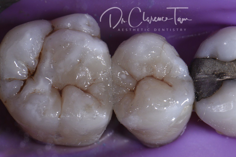 Natural Looking Amalgam Replacements on my Mom