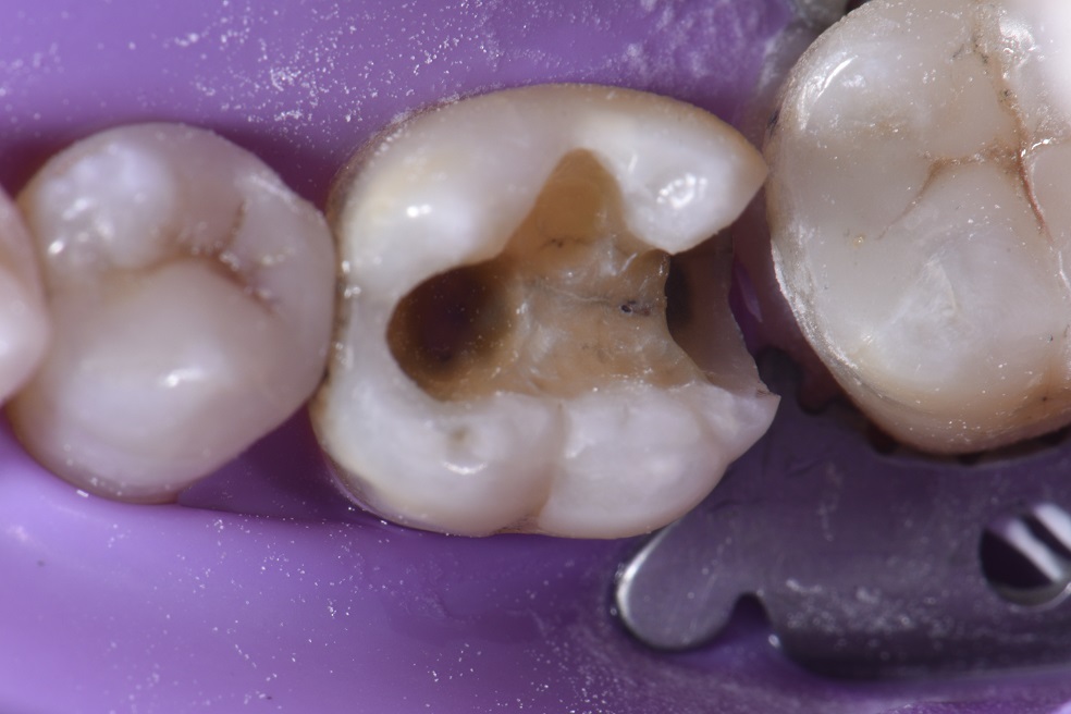 Replacing my father's large amalgam with GC Essentia U