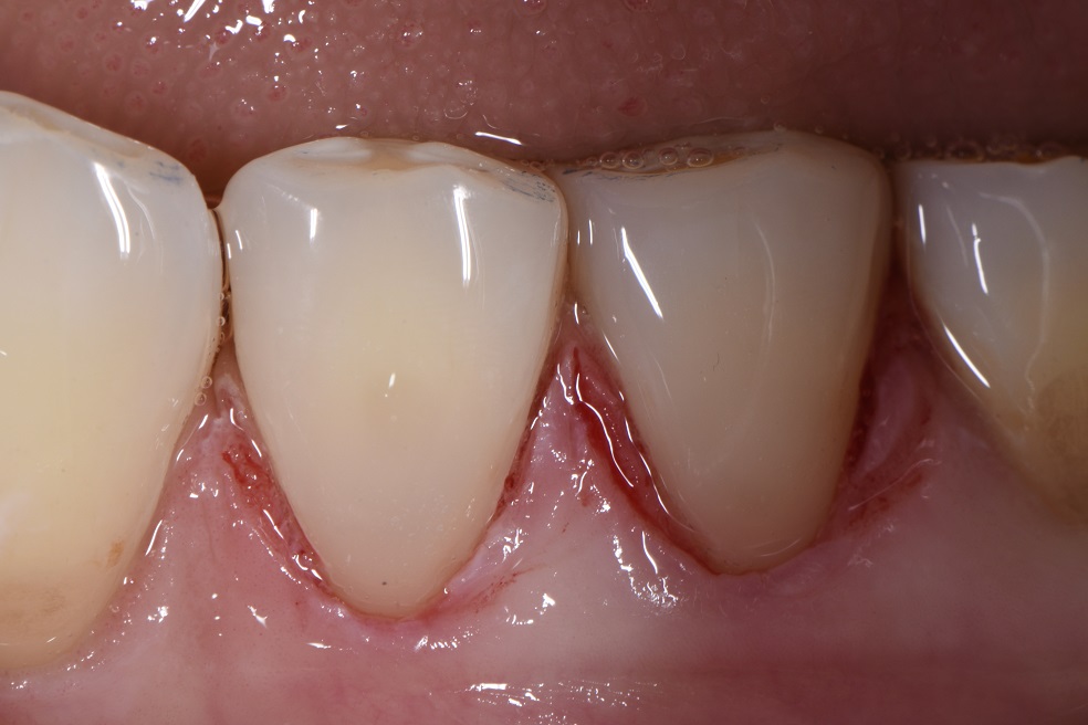 Class V restorations