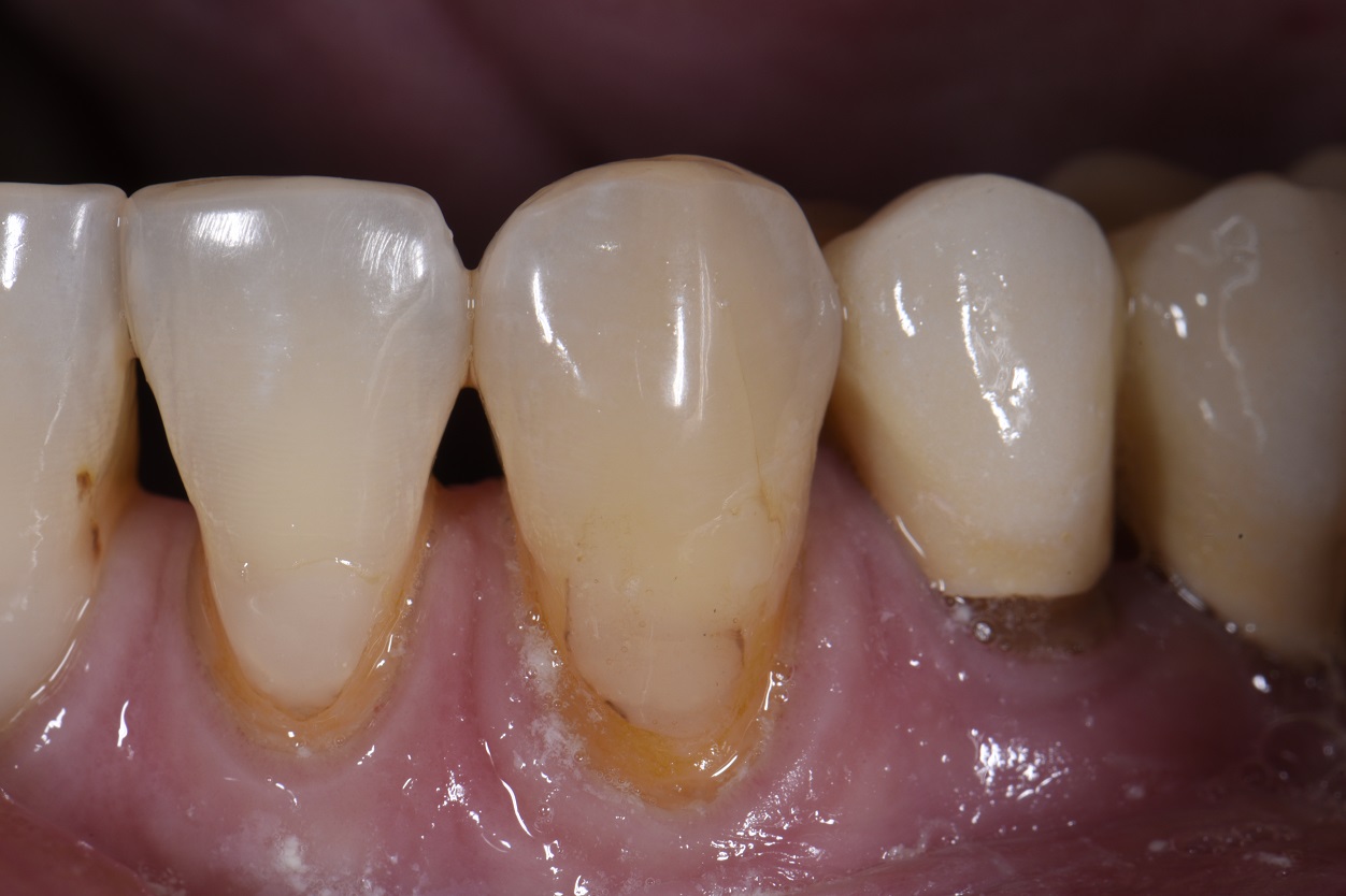 Class V Restorations using GC Essentia U, G-MultiPrimer and G-Premio Bond