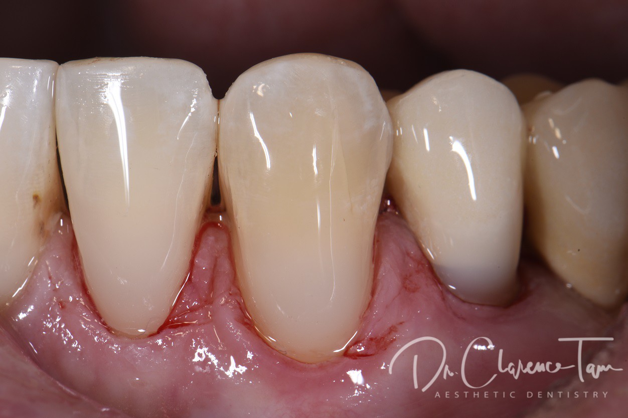 Class V Restorations using GC Essentia U, G-MultiPrimer and G-Premio Bond