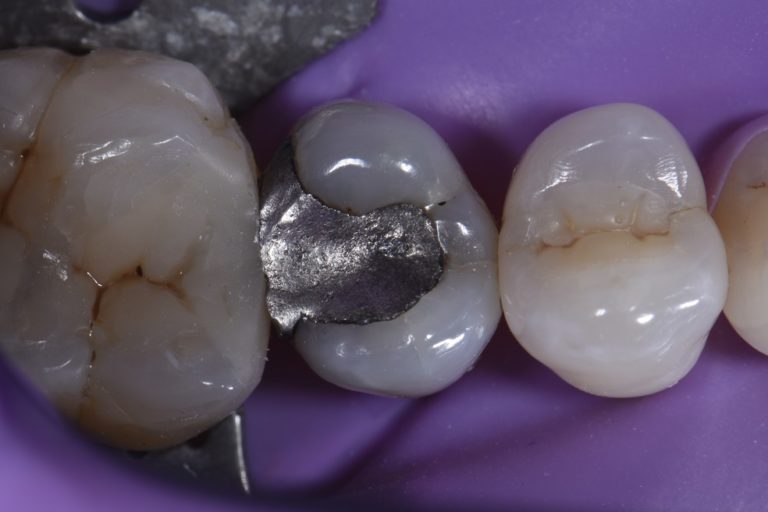 Replacing Large Old Amalgams with Fresh Bonded Composite