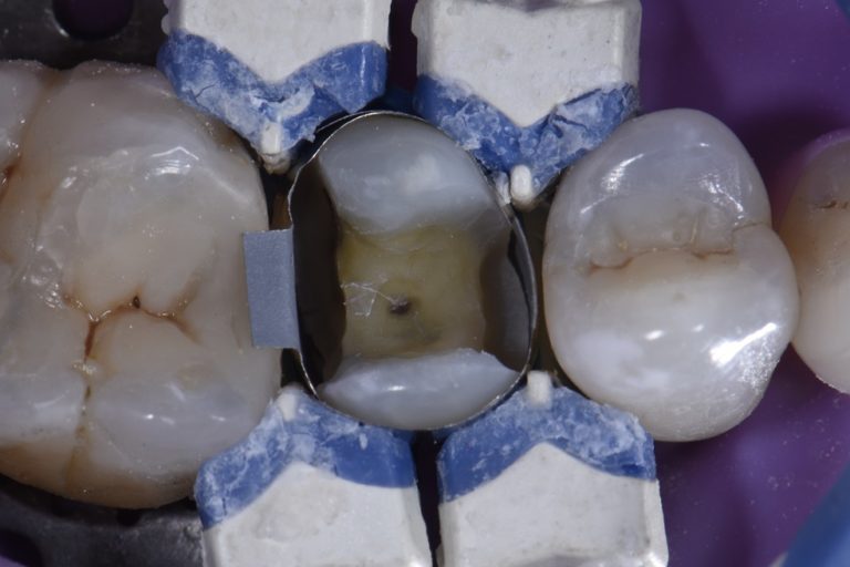 Replacing Large Old Amalgams with Fresh Bonded Composite