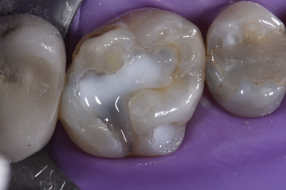 Using Supercomposites to replace Large Fillings