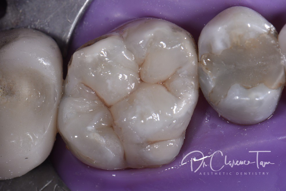 Using Supercomposites to replace Large Fillings