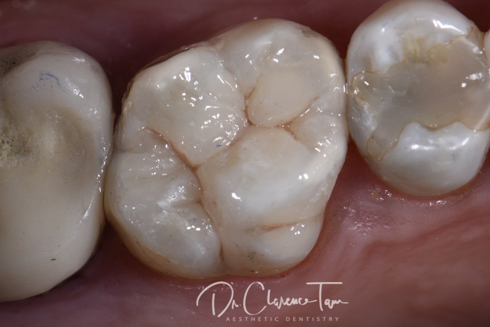 Using Supercomposites to replace Large Fillings