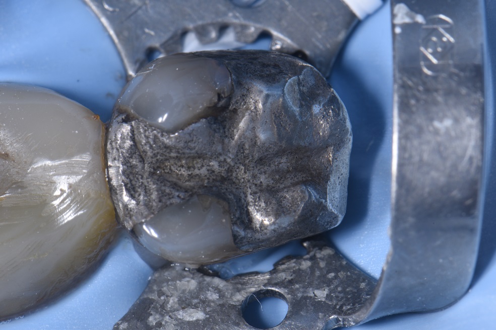 Replacing Extensive Amalgam Restorations with Composite Cores