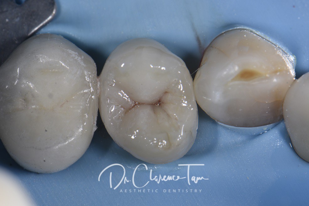 Premolar Rebuilt using a Supercomposite Resin