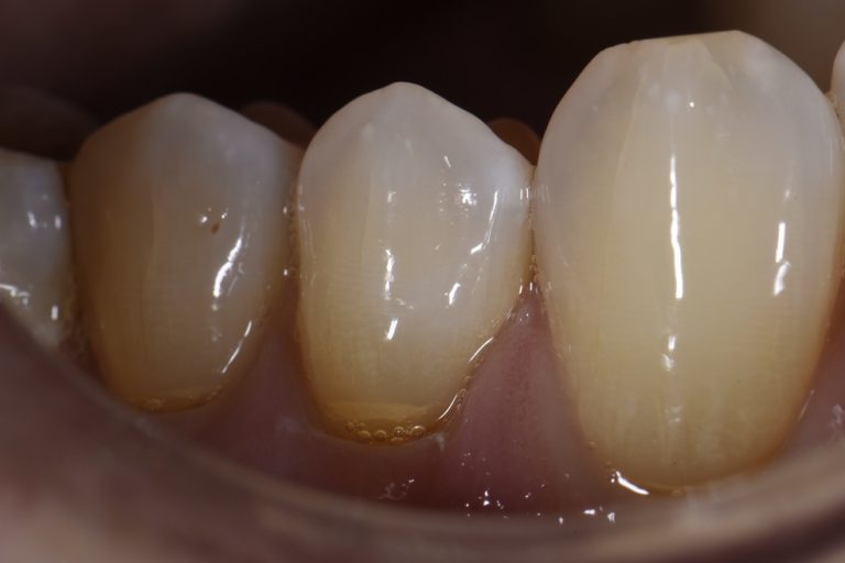 Class V lesions restored seamlessly