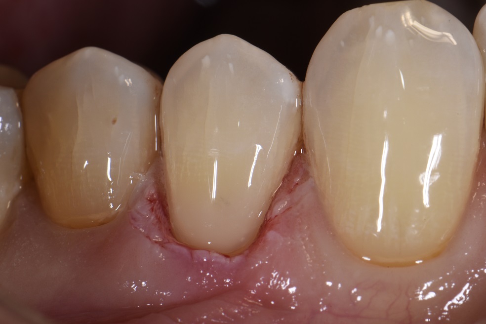 Class V lesions restored seamlessly