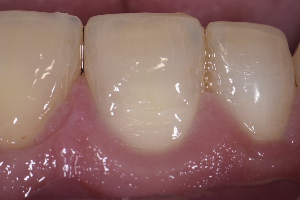 All Access Surface Polishers ASAP Clinicians Choice