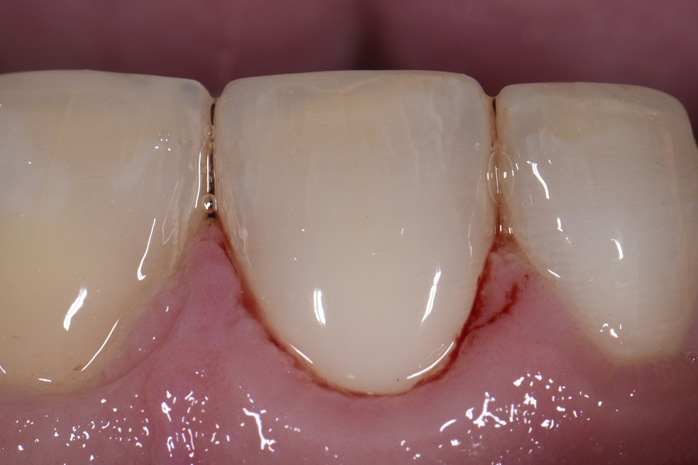 All Access Surface Polishers ASAP Clinicians Choice