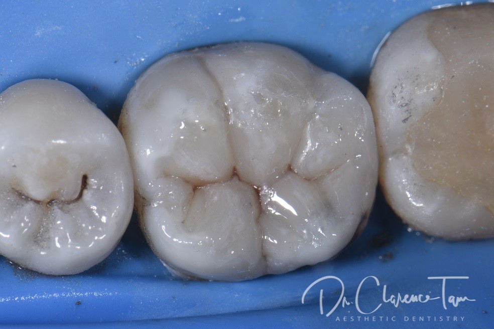 Large Amalgam Filled Tooth Restored Biomimetically