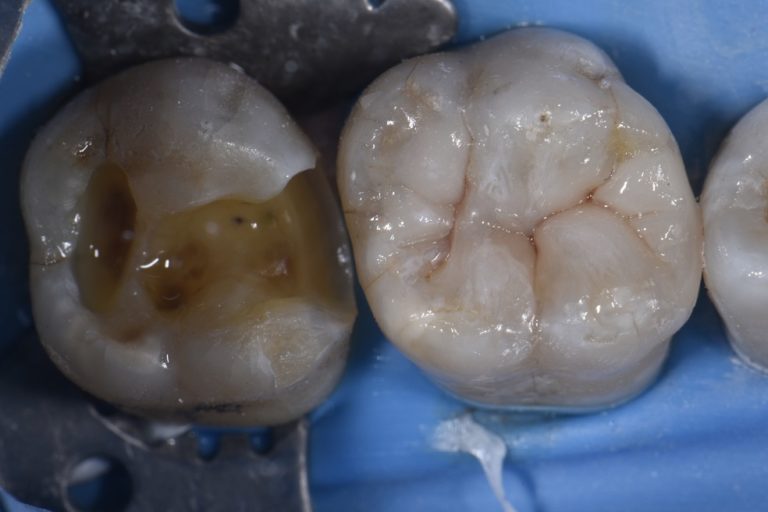 Supercomposite Replacements for Structurally Compromised Teeth