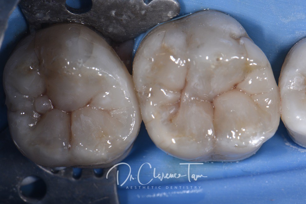 Supercomposite Replacements for Structurally Compromised Teeth