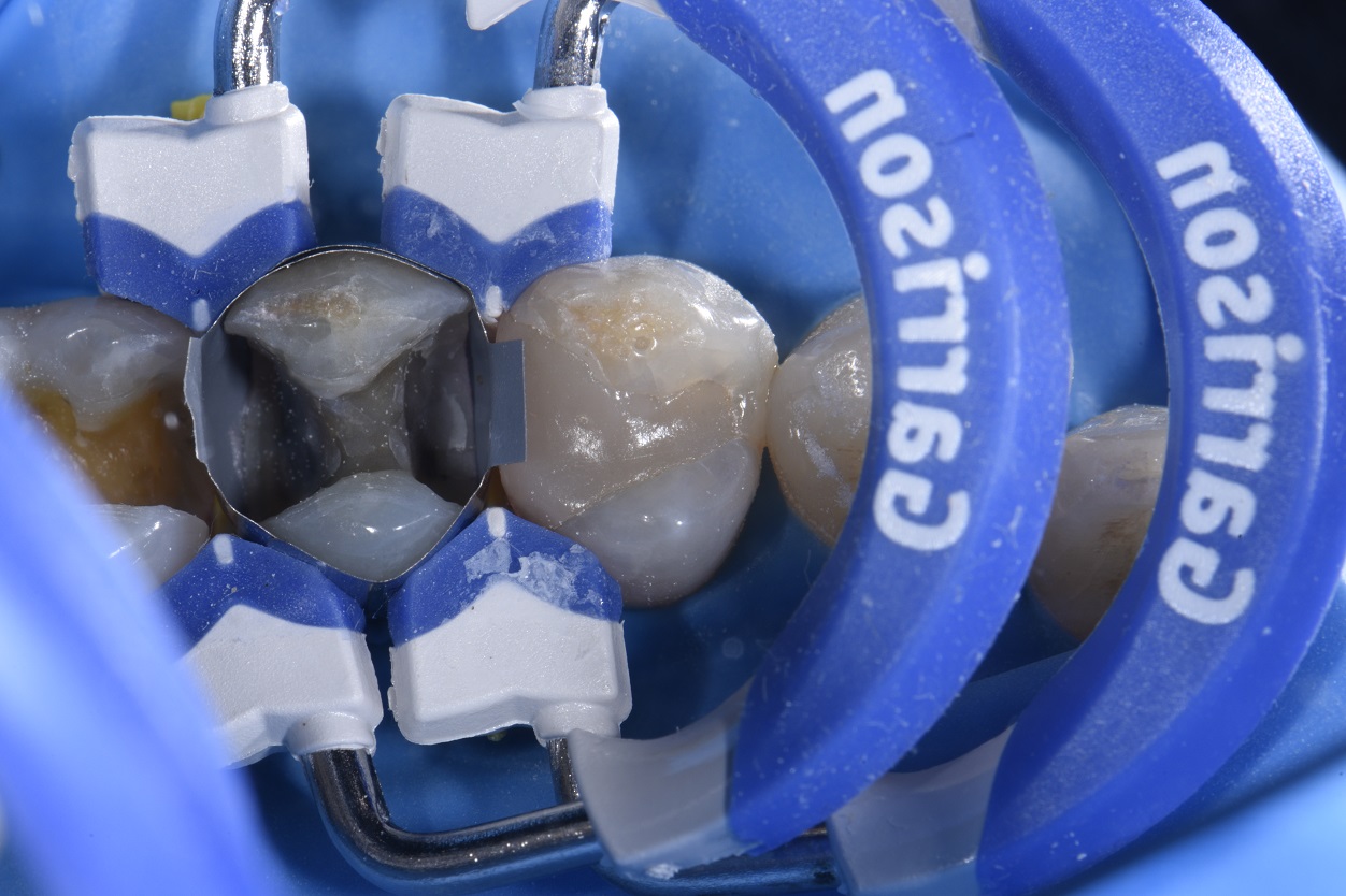 Classic Class II restorations done biomimetically