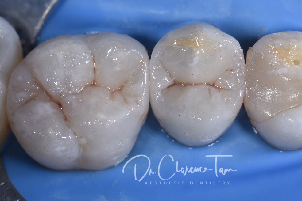 Classic Class II restorations done biomimetically