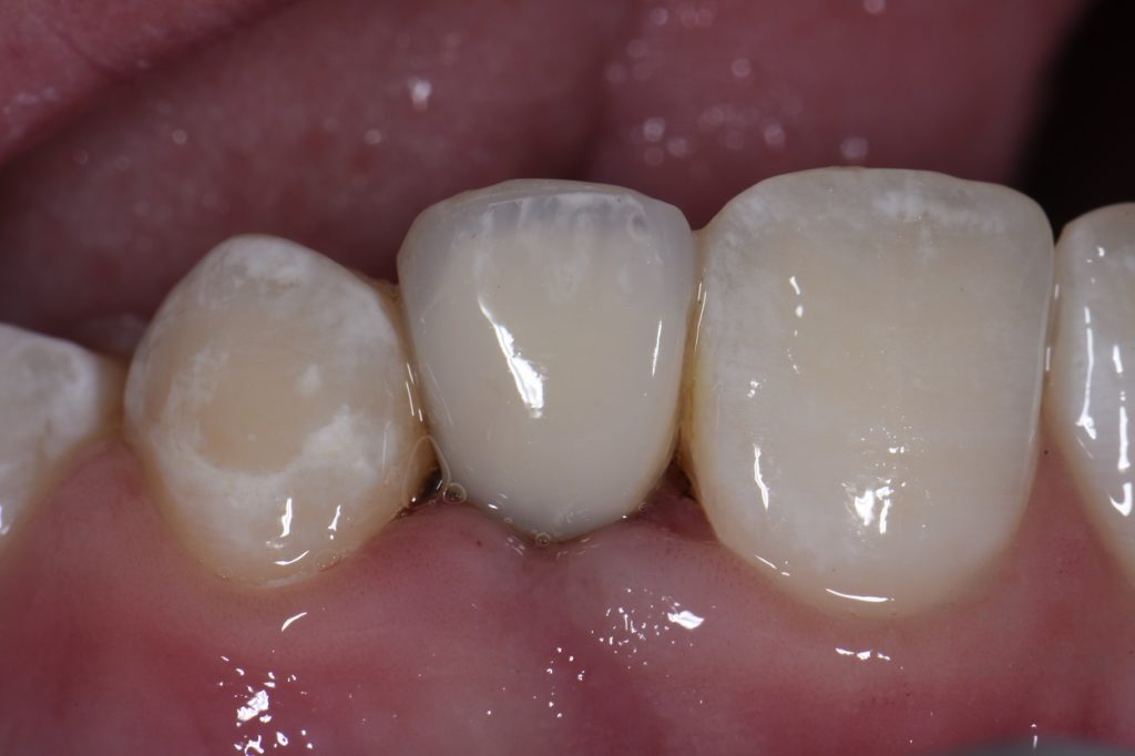 Temporary Composite Bridges