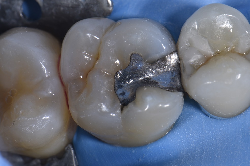Amalgam Replacement with Bonded Composite Resin
