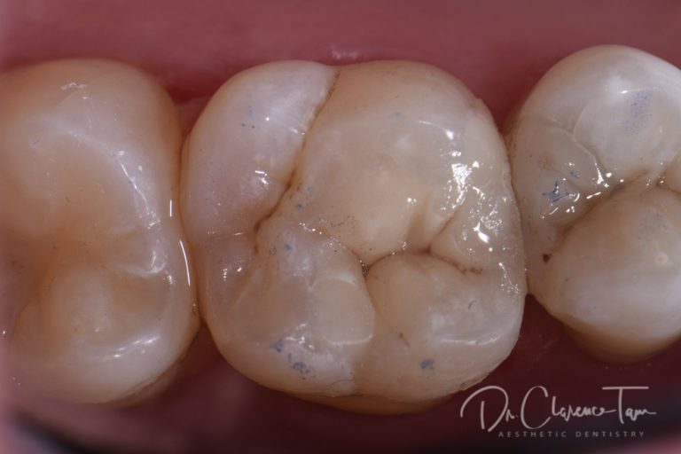 Amalgam Replacement with Bonded Composite Resin