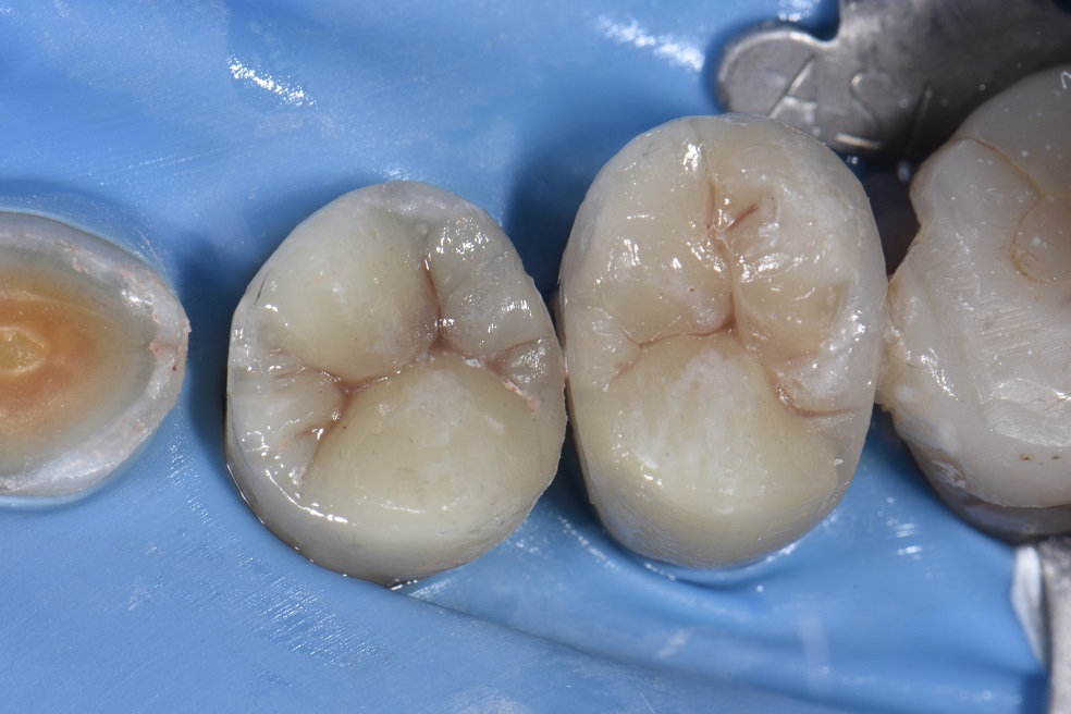 Large Core Buildups before Bite Modification