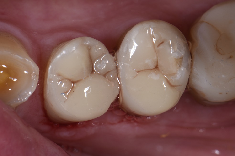 Large Core Buildups before Bite Modification