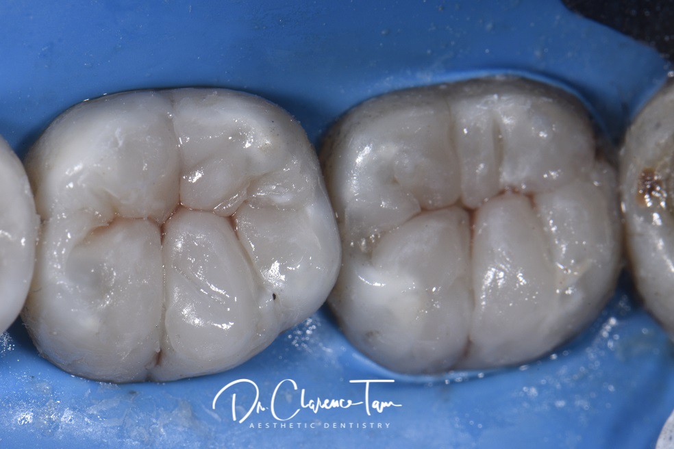 Shofu Beautiful LS First Trial