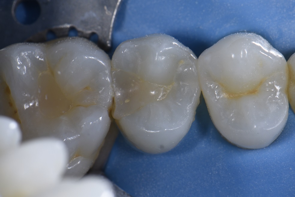 Shofu Beautiful II LS Class II