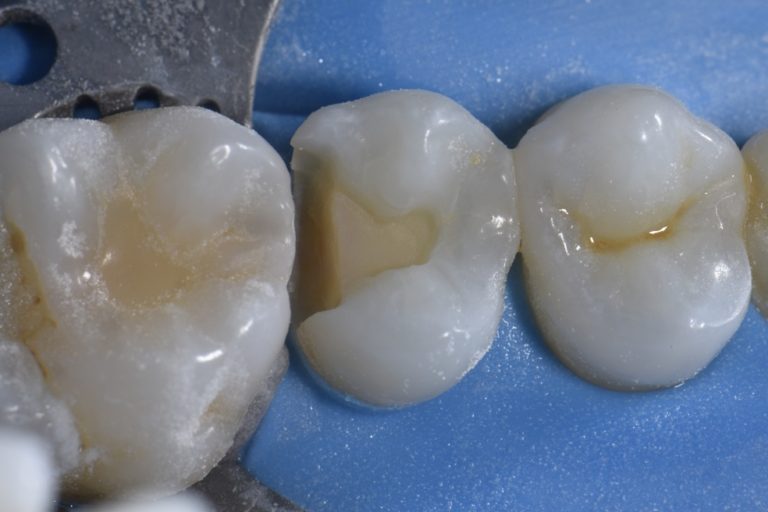 Shofu Beautiful II LS Class II