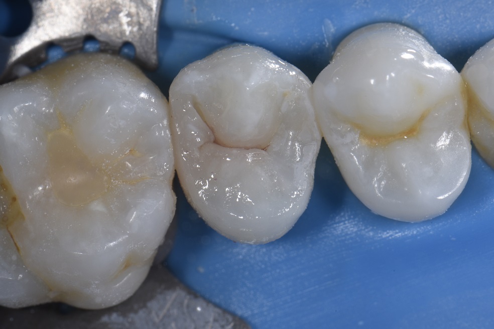 Shofu Beautiful II LS Class II