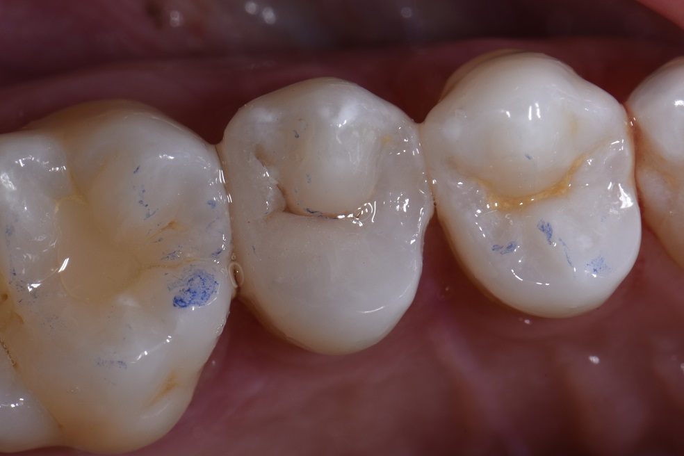 Shofu Beautiful II LS Class II