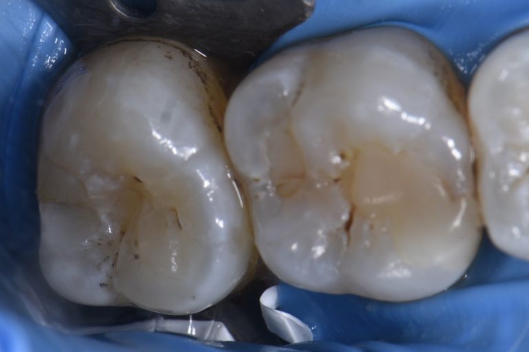 Garrison Wide Prep Sectional Matrix Retainer | Shofu Beautiful II LS