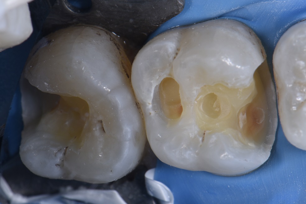 Garrison Wide Prep Sectional Matrix Retainer | Shofu Beautiful II LS