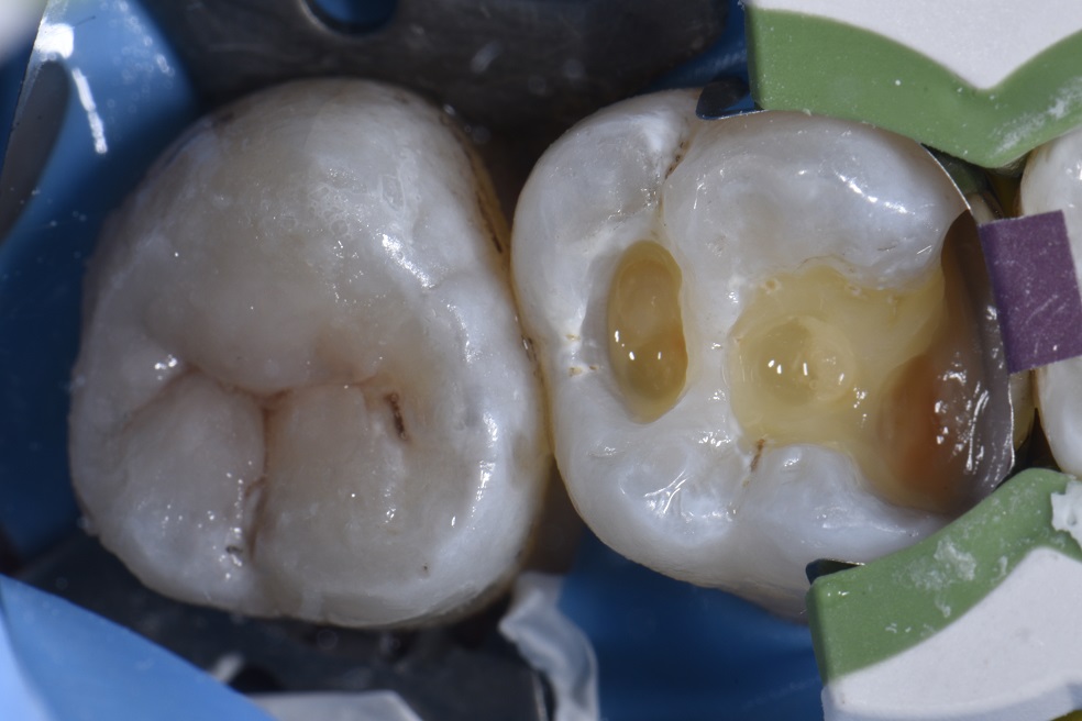 Garrison Wide Prep Sectional Matrix Retainer | Shofu Beautiful II LS