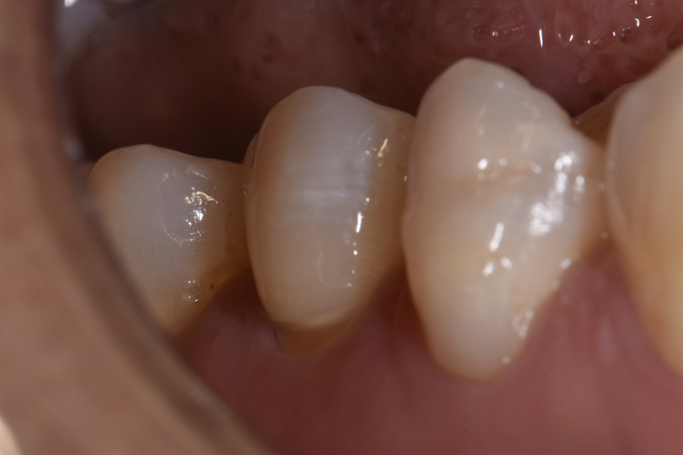 GC Essentia U Root Lightening Restorations