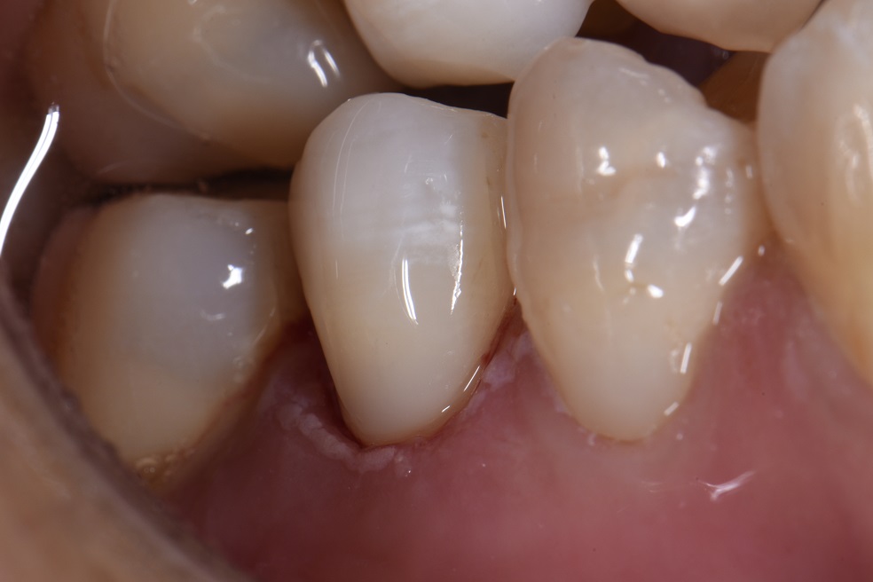 GC Essentia U Root Lightening Restorations