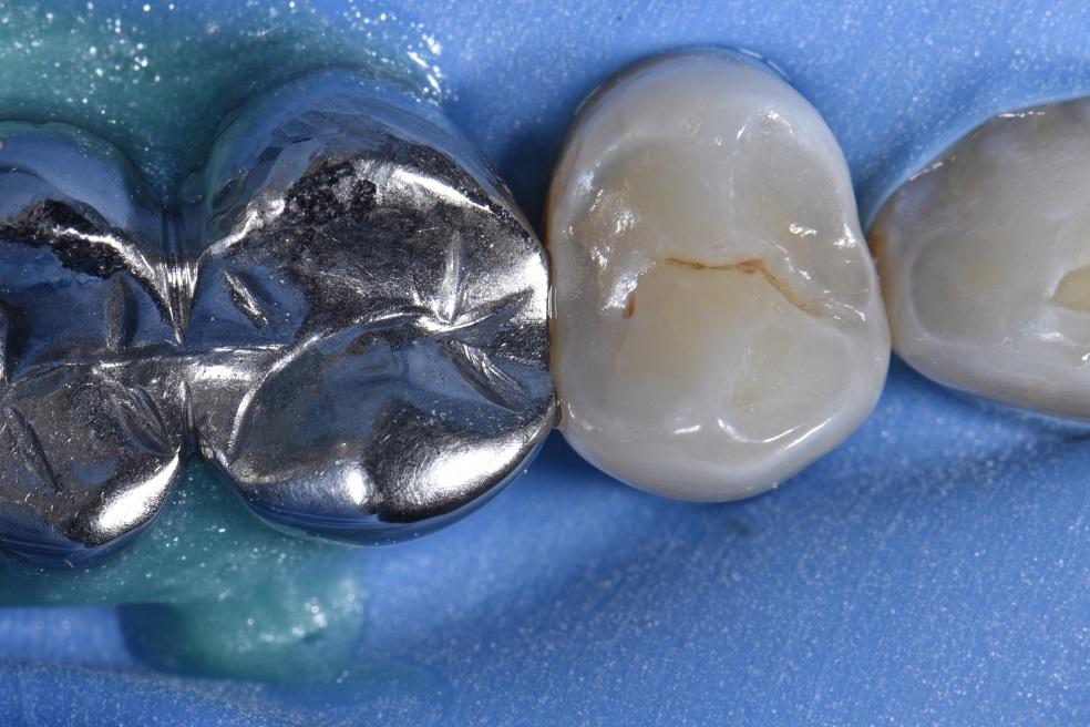 Shofu Beautiful II LS Class II