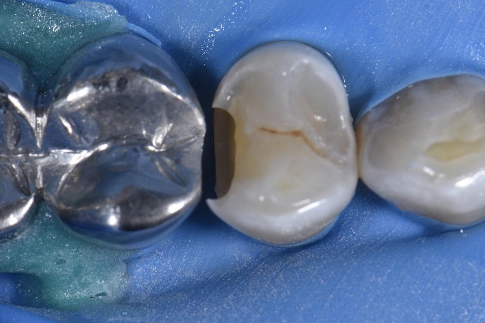 Shofu Beautiful II LS Class II