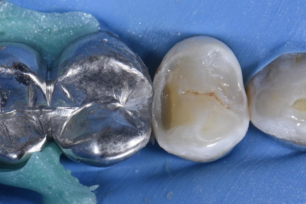 Shofu Beautiful II LS Class II