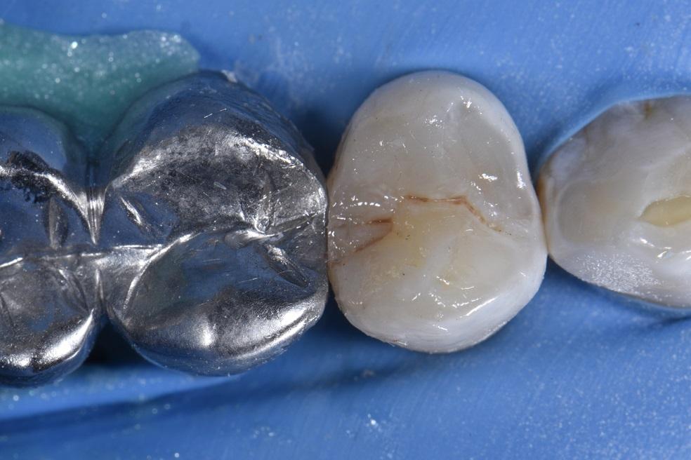 Shofu Beautiful II LS Class II