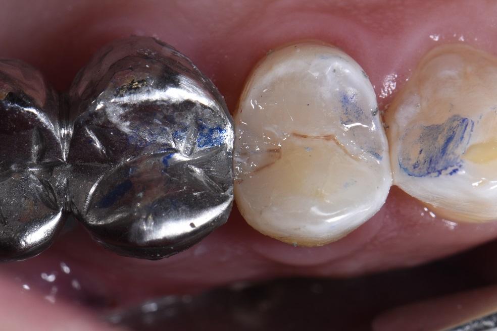 Shofu Beautiful II LS Class II