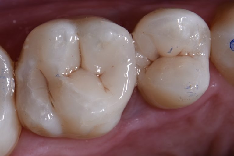 Biomimetic and Bioactive Composite Resin restorations