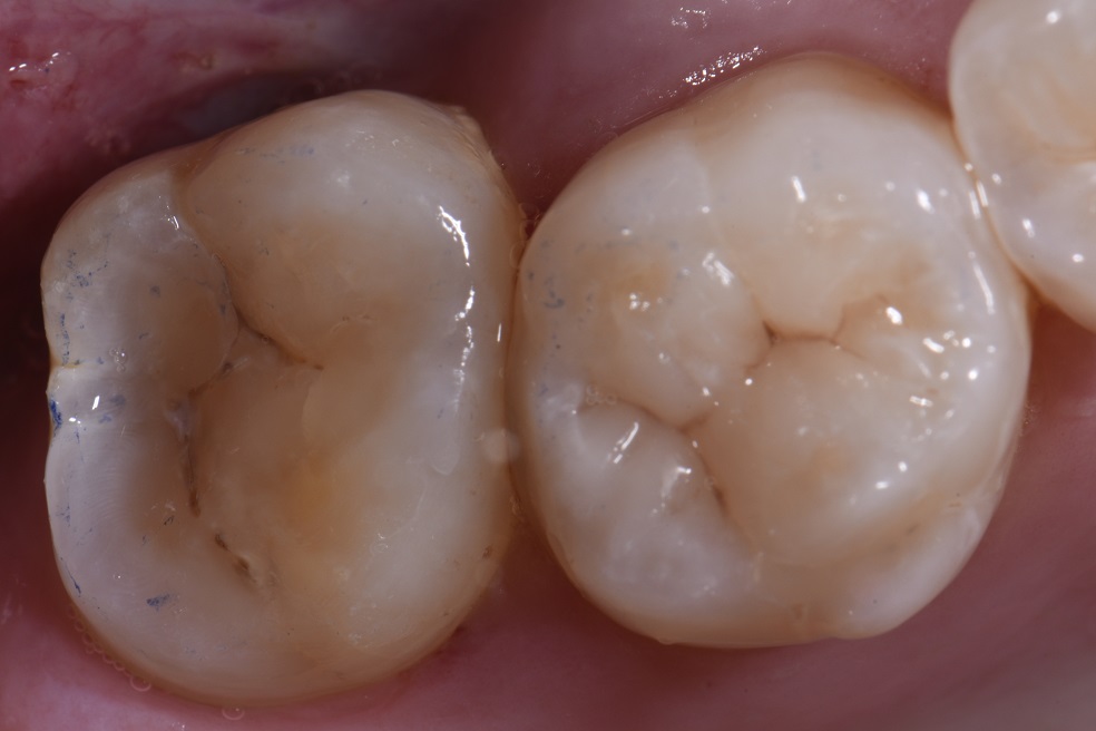 Reversing Erosive Damage on Teeth with Composite Resin